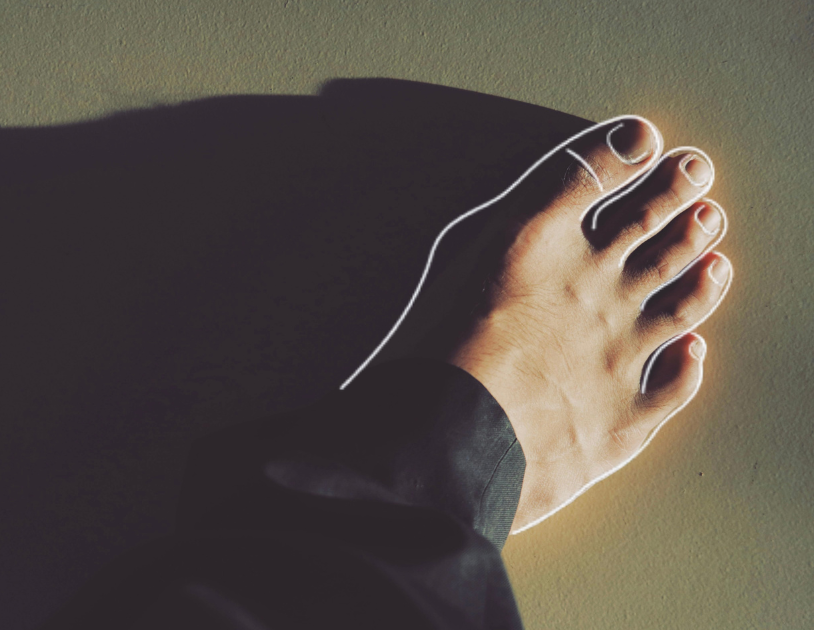 Hallux valgus ehk suure varba deformatsioon– sümptomid ja ravi. - Profysio